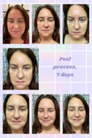 Chemical Peels - Reading Dermatology