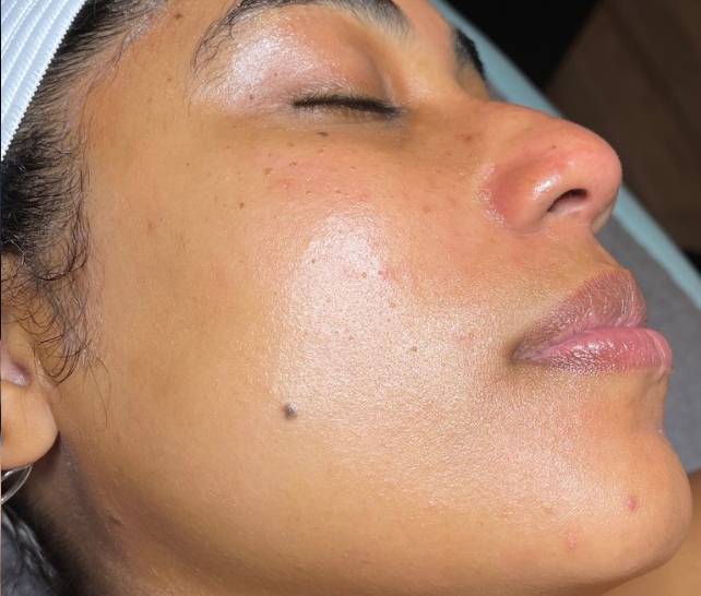 Dermaplaning Archives - Reading Dermatology