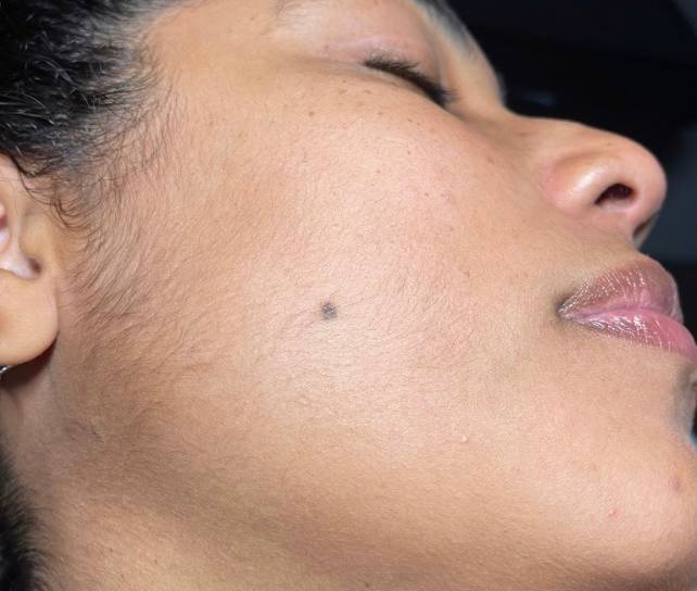Dermaplaning - Reading Dermatology
