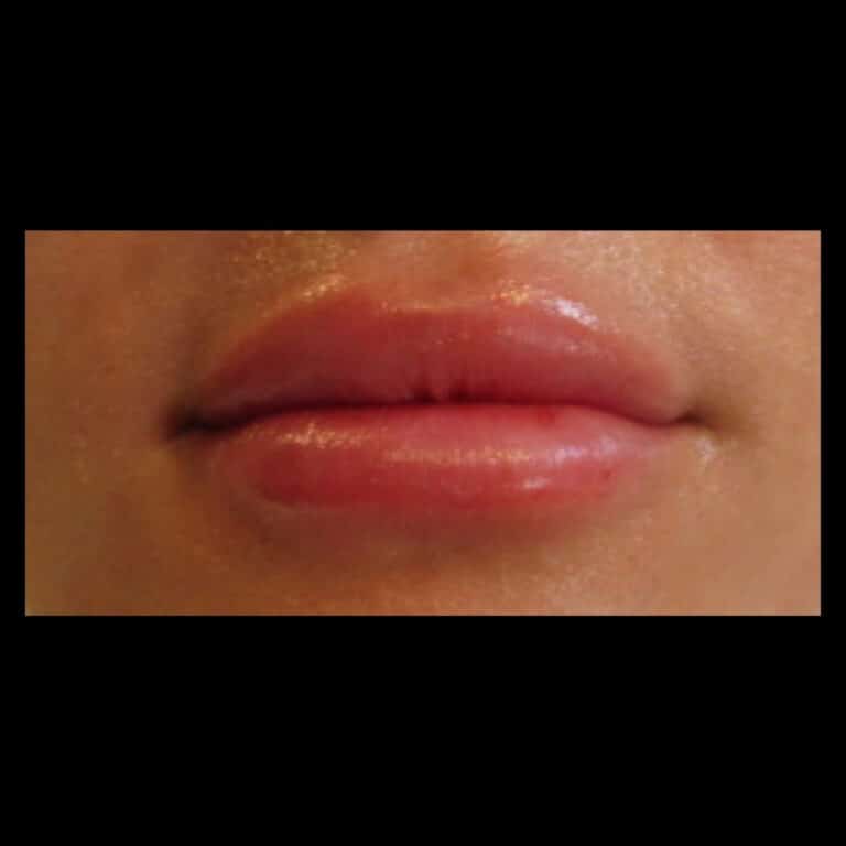 Lip Filler - Reading Dermatology