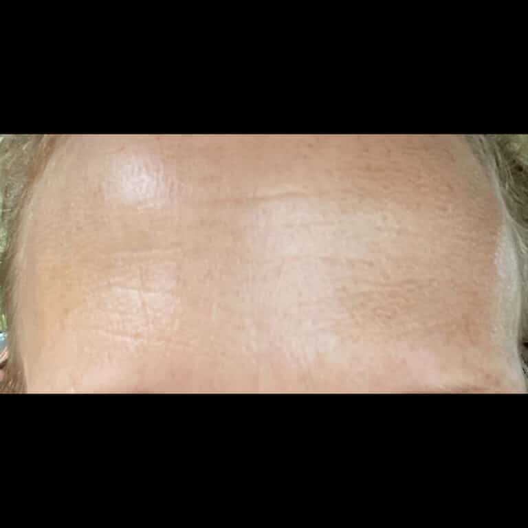Forehead Lines - Reading Dermatology