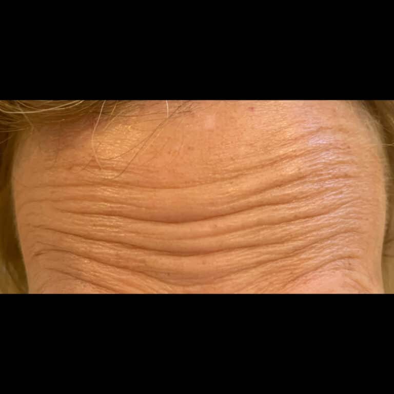 Forehead Lines - Reading Dermatology