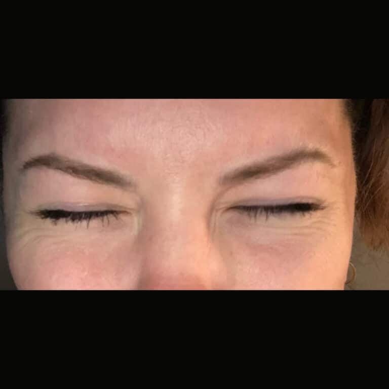 Forehead 11's - Reading Dermatology