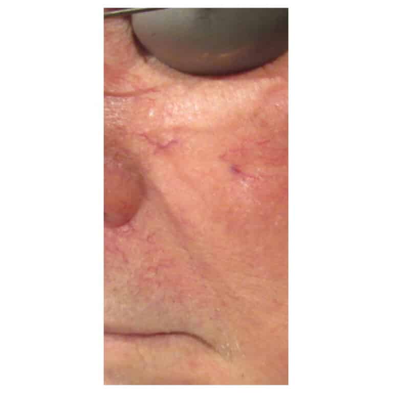 Laser Treatments - Reading Dermatology