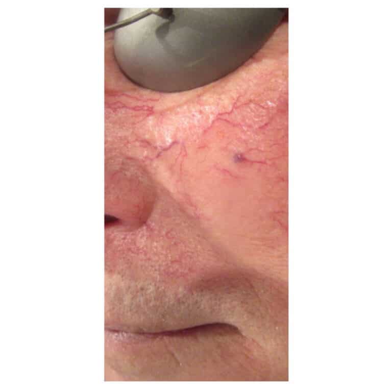 Laser Treatments - Reading Dermatology